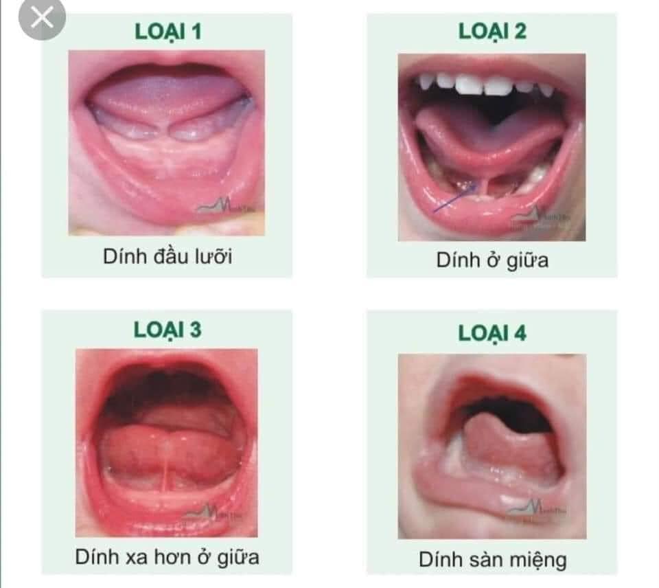 DÍnh ThẮng LƯỠi Trung Tâm Giáo Dục đặc Biệt Hải Dương